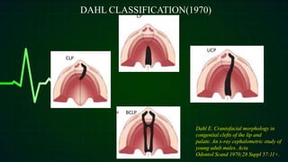 CLEFT LIP AND PALATE | PPTX