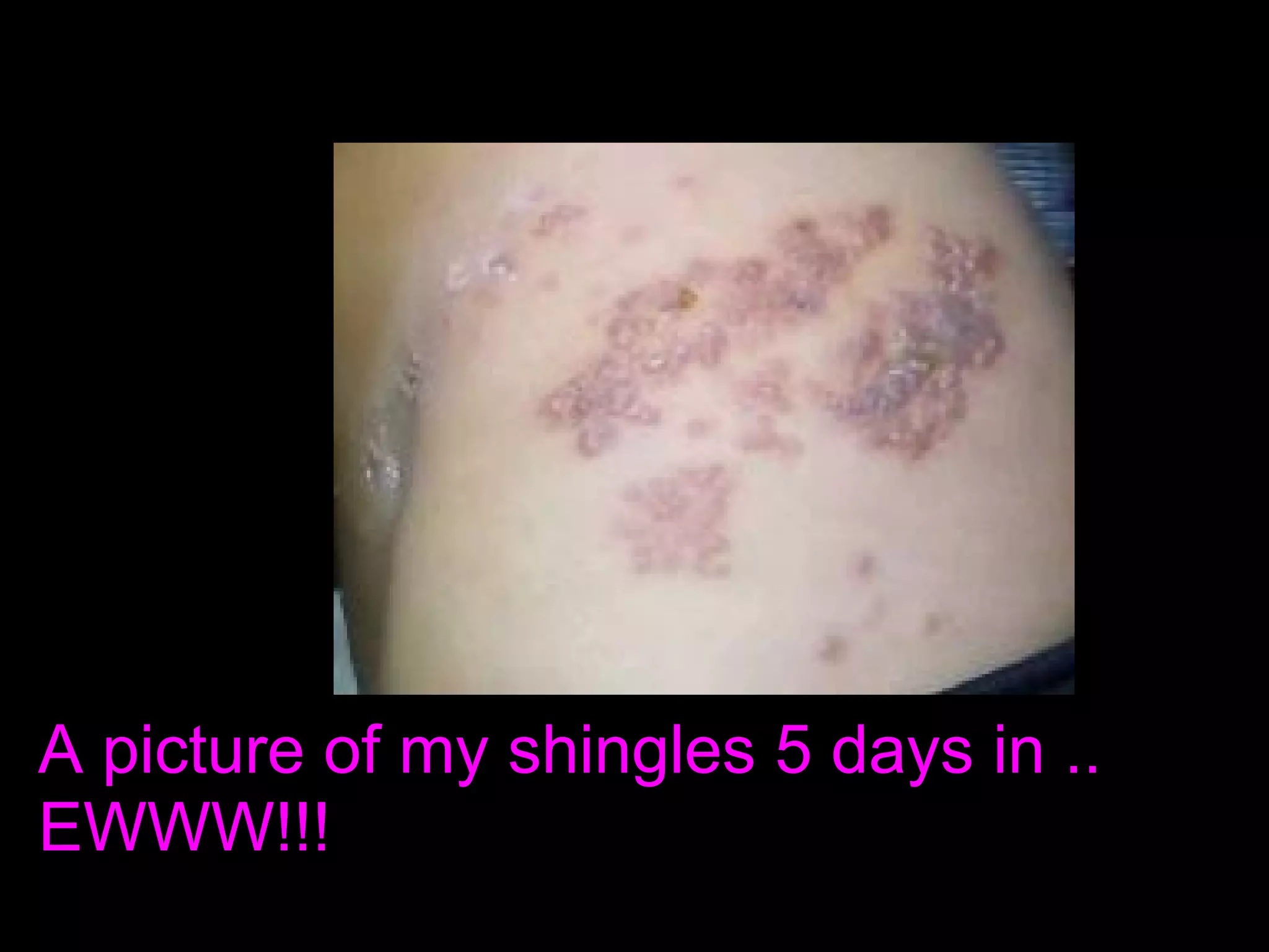Shingles | PDF