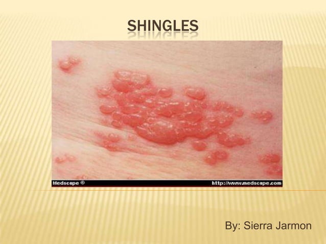 Shingles | PPTX | Infectious Diseases | Diseases and Conditions