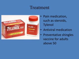 Shingles | PPT