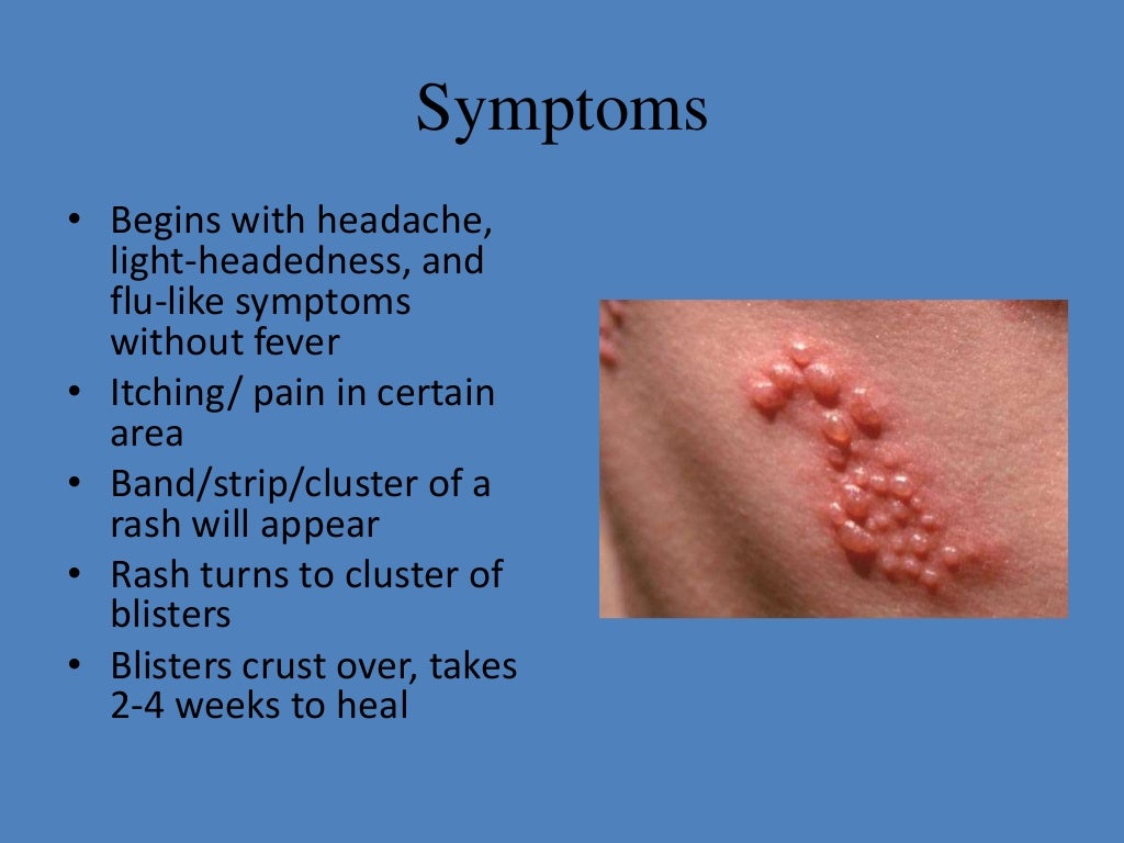 Shingles