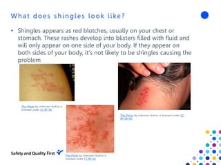 The Shingles Diseases Presentation.pptx