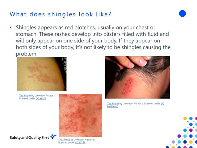 The Shingles Diseases Presentation.pptx | Infectious Diseases ...
