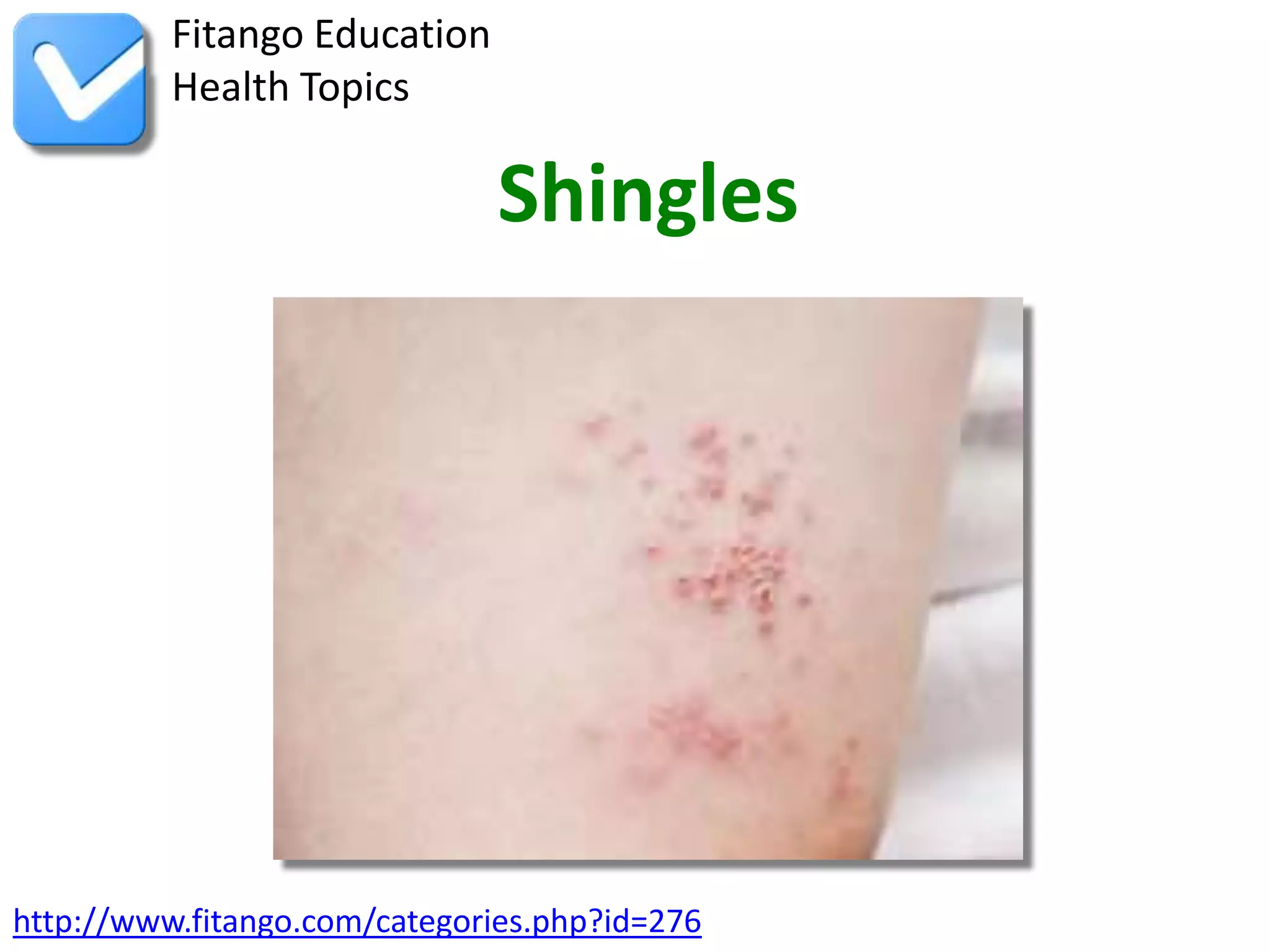 Shingles | PPTX