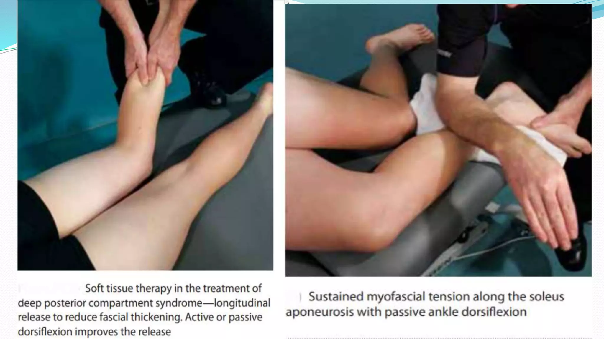 Shin pain shin splint | PPTX