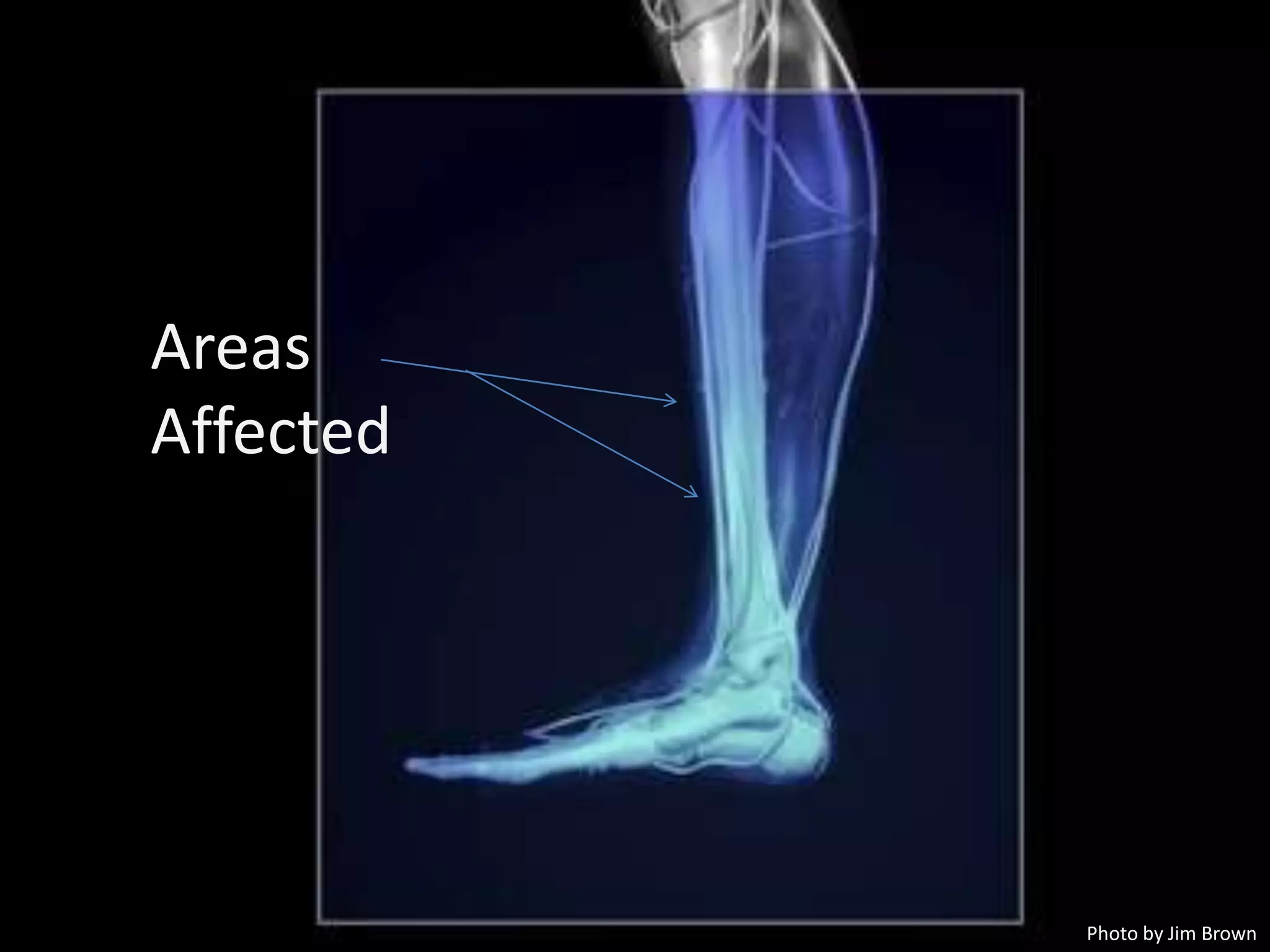 Shin Splint Presentation | PPTX