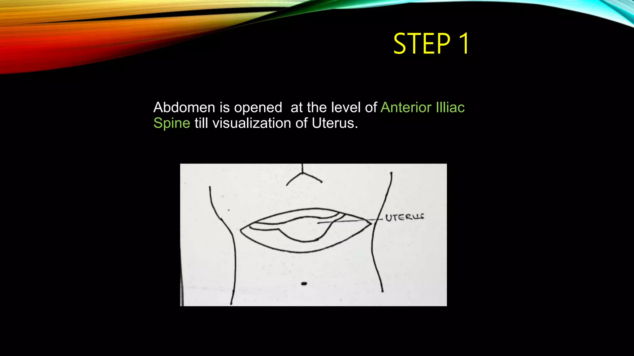 Shirodkar sling surgery | PPTX