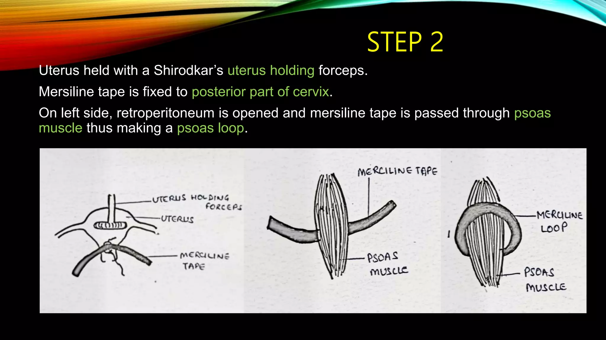 Shirodkar sling surgery | PPTX