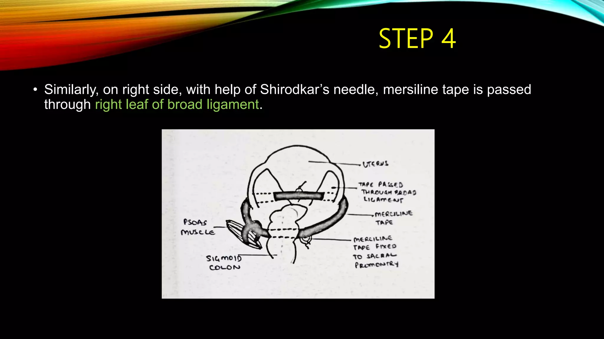 Shirodkar sling surgery | PPTX