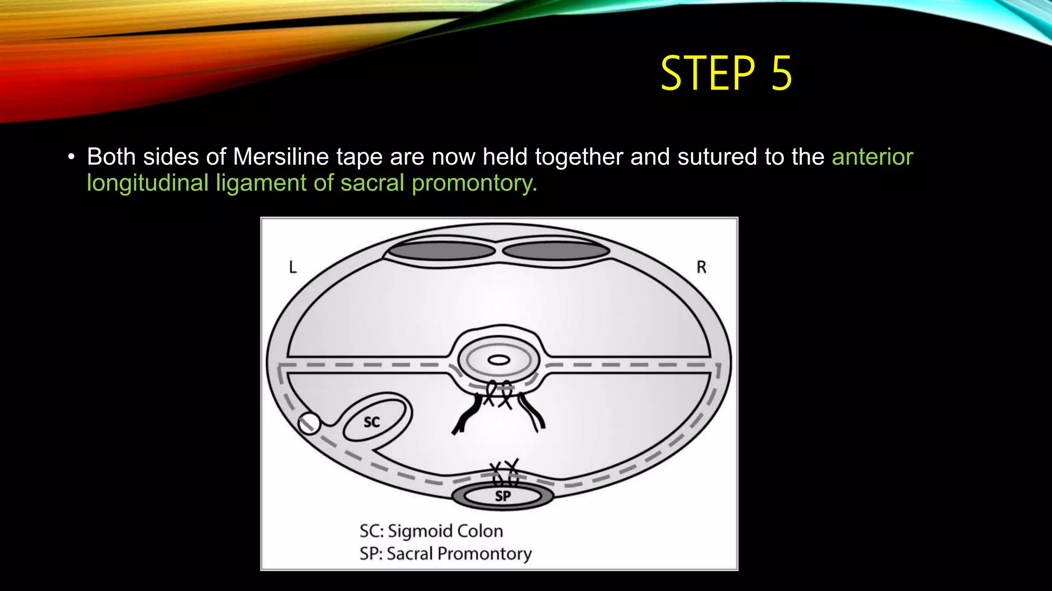 Shirodkar sling surgery | PPTX