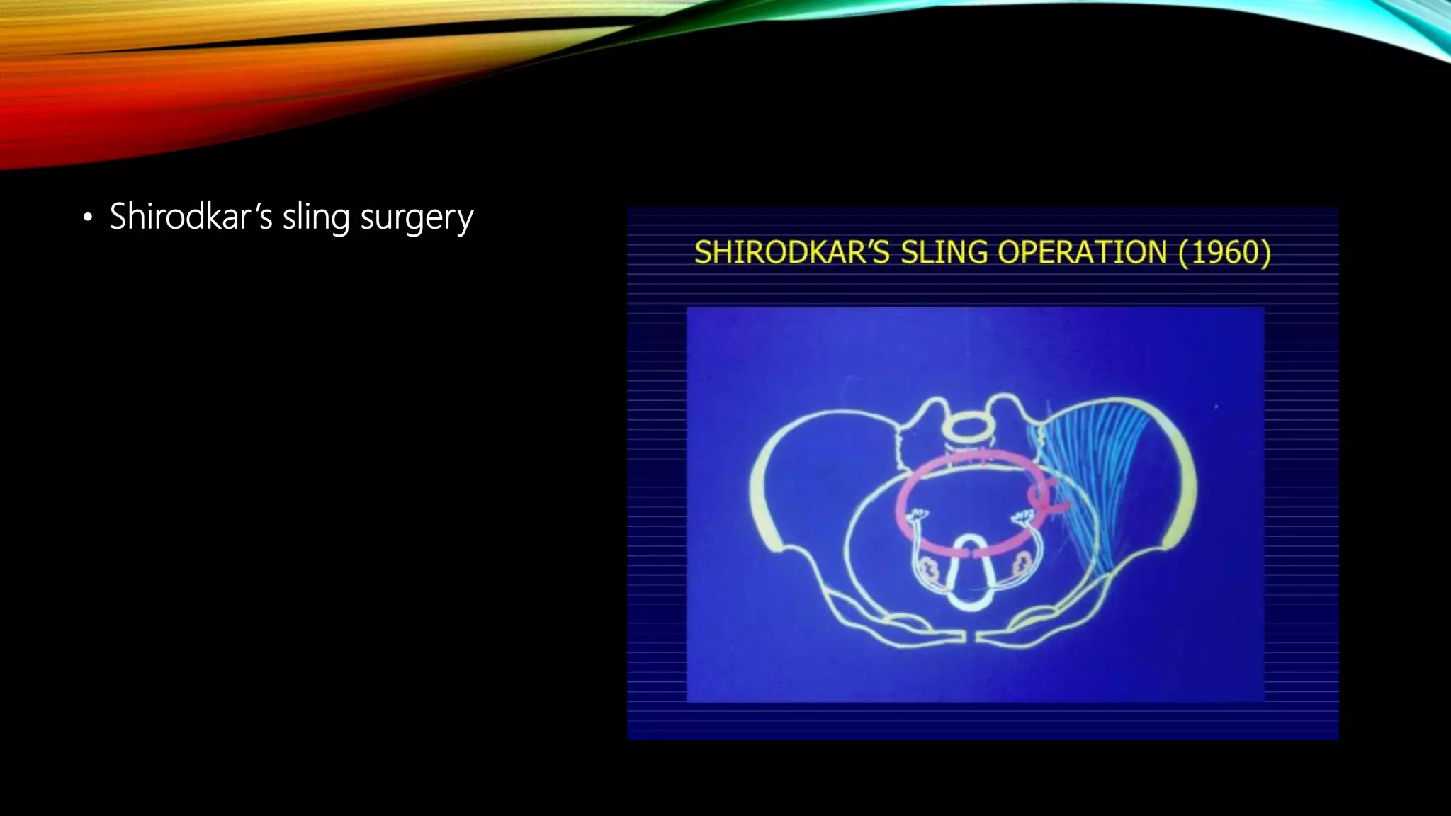 Shirodkar sling surgery | PPTX