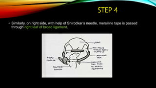 Shirodkar sling surgery | PPTX