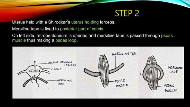 Shirodkar sling surgery | PPT