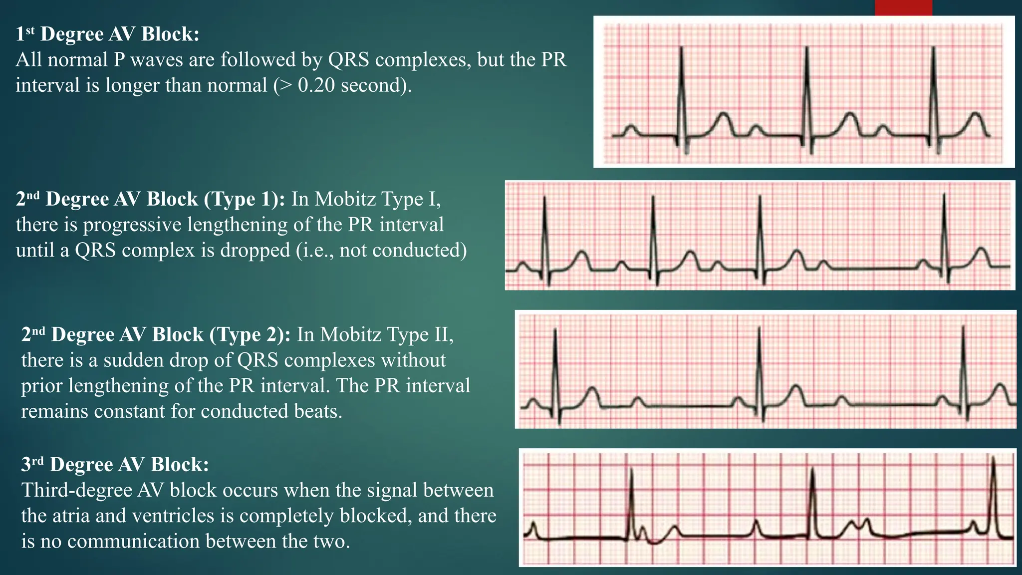 Pathology of Heart and in its conduction. | PPT