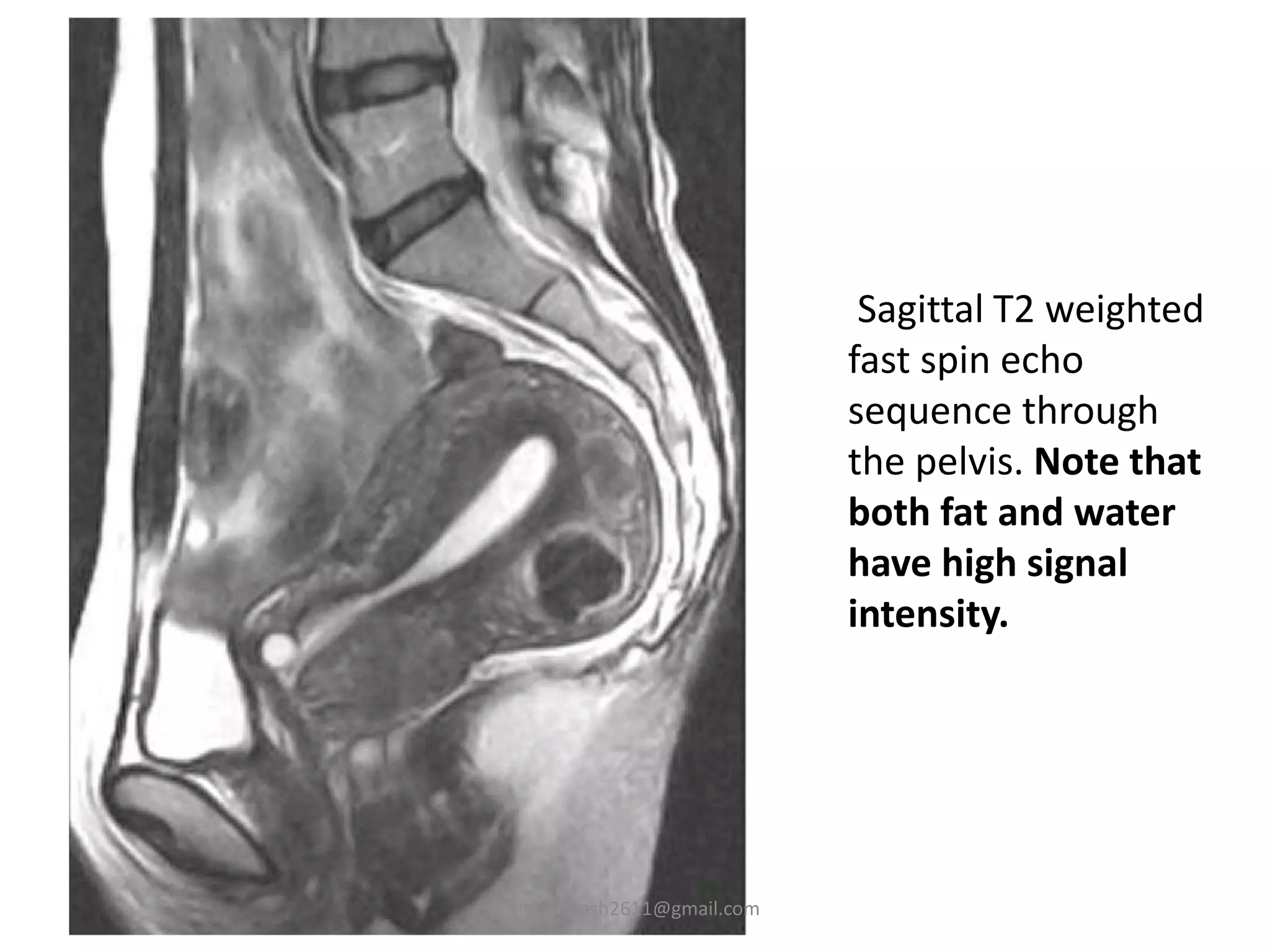 MRI spin echo pulse sequences | PPTX
