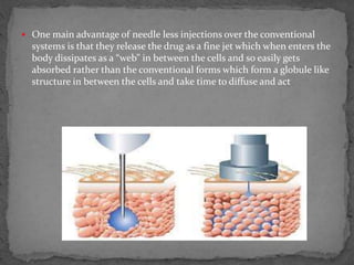 Needle Less Injection Technology by S Shivani Shastrulagari. | PPTX ...