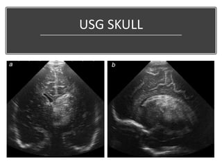 Hypernatremic dehydration with cerebral venous thrombosis in neonate. | PPT