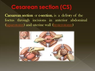 Cesarian section and physical therapy role | PDF | Pregnancy ...