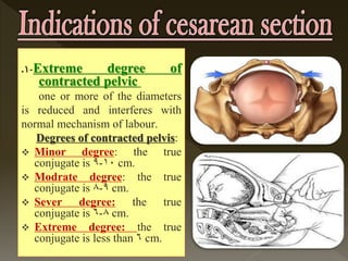 Cesarian section and physical therapy role | PDF