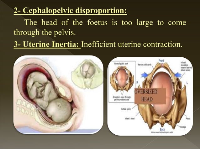Cesarian section and physical therapy role | PPT