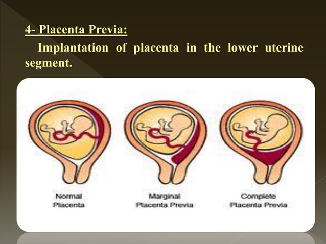 Cesarian section and physical therapy role | PPT
