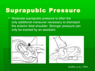 Shldr dystocia acog | PPT