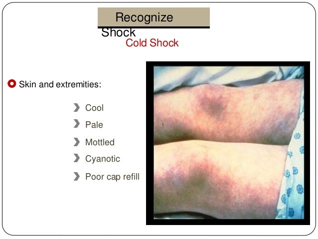 Shock and it's classification