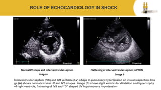 management of shock in neonates | PPTX