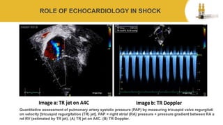 management of shock in neonates | PPTX