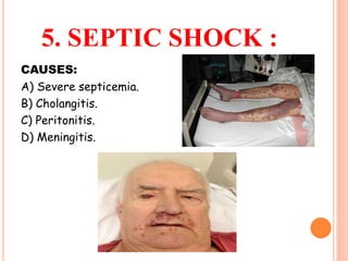 Shock and types of shock | PPTX