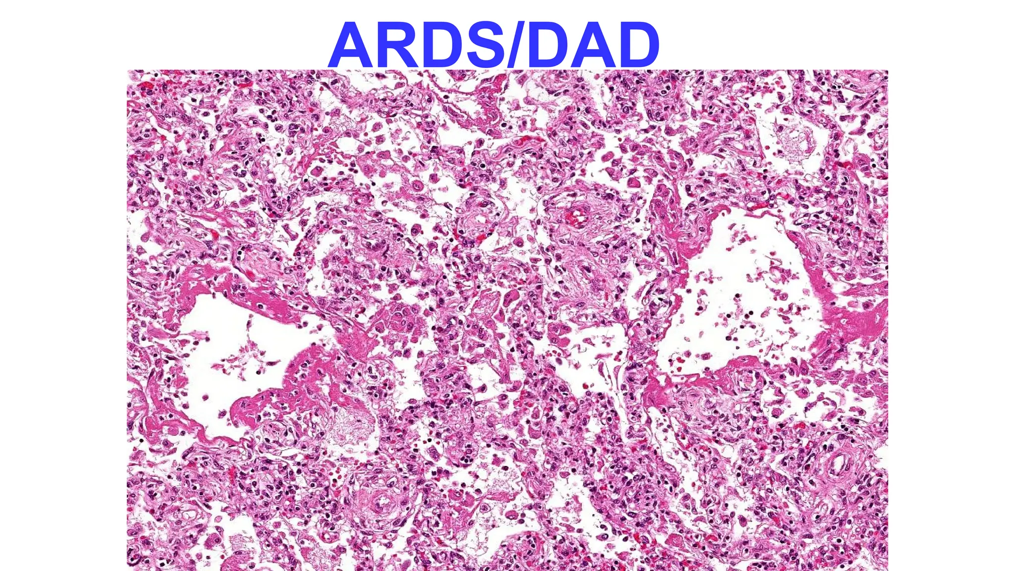 SHOCKMULTIPLE ORGAN FAILURE SUBENDOCARDIAL HEMORRHAGE ACUTE TUBULAR ...