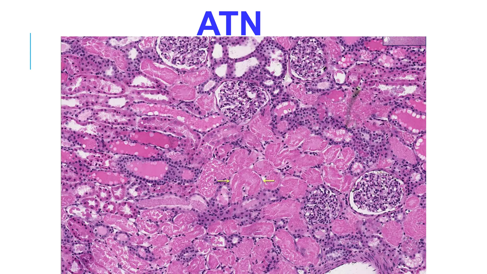 SHOCKMULTIPLE ORGAN FAILURE SUBENDOCARDIAL HEMORRHAGE ACUTE TUBULAR ...