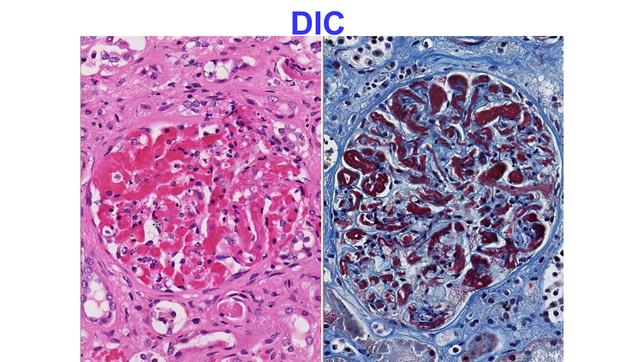 SHOCKMULTIPLE ORGAN FAILURE SUBENDOCARDIAL HEMORRHAGE ACUTE TUBULAR ...