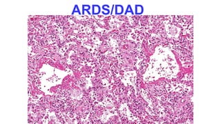 SHOCKMULTIPLE ORGAN FAILURE SUBENDOCARDIAL HEMORRHAGE ACUTE TUBULAR ...