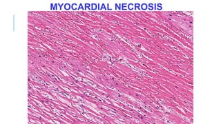 SHOCKMULTIPLE ORGAN FAILURE SUBENDOCARDIAL HEMORRHAGE ACUTE TUBULAR ...