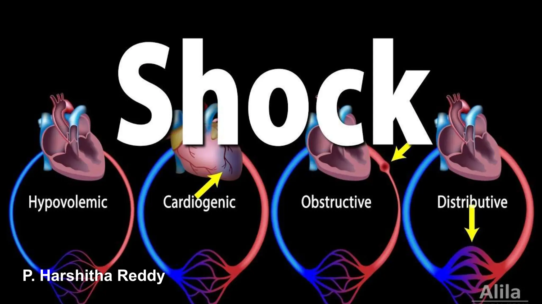 Shock / Types of Shock / Stages of Shock / Management of Shock | PDF