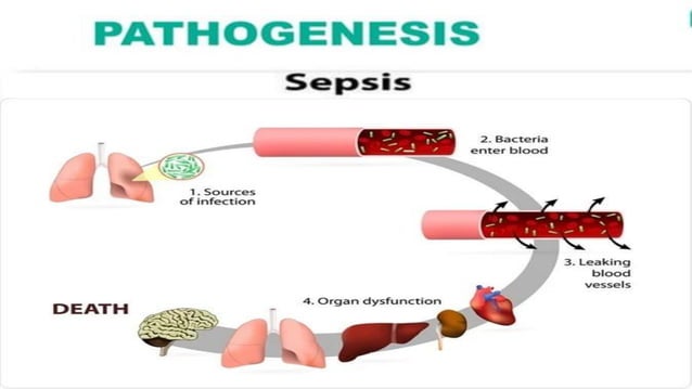 Shock - Septic + Hypovolemic - Causes & Management | PDF | First Aid ...