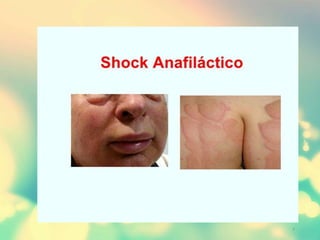 Shock distributivo | PPTX