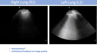 Shock, respiratory failure, and a chest xray | PPTX