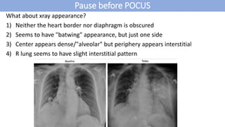 Shock, respiratory failure, and a chest xray | PPTX