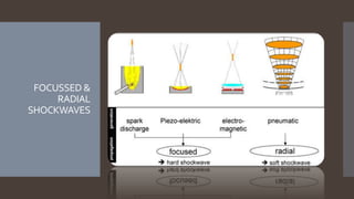 Shock wave therapy (swt) | PPTX