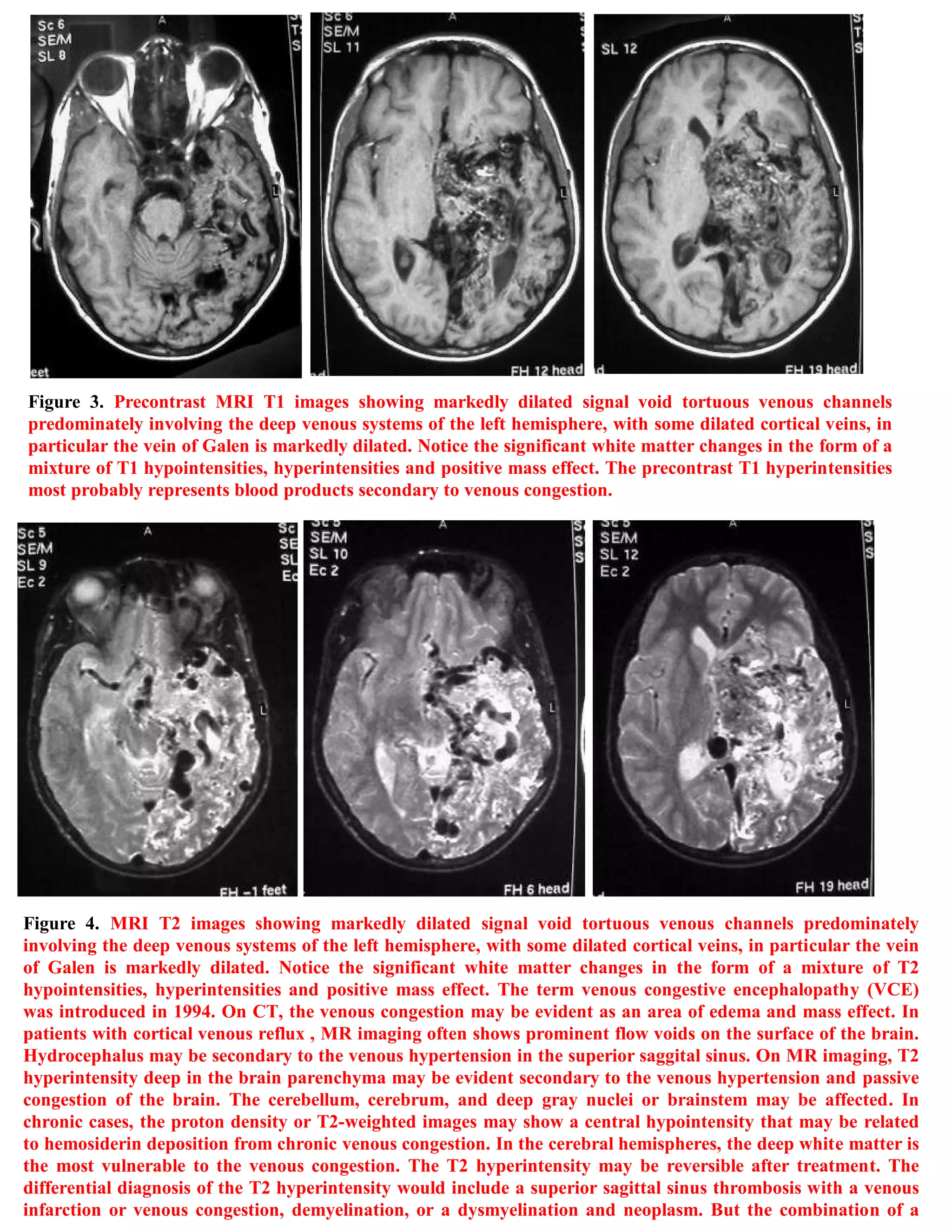 Short case...Multiple dural arteriovenous fistulas | PDF