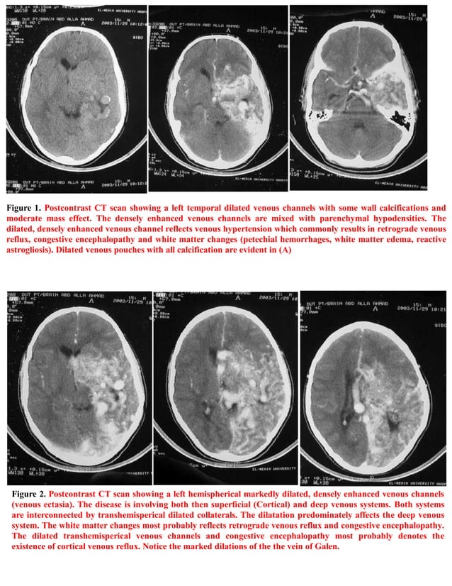 Short case...Multiple dural arteriovenous fistulas | PDF
