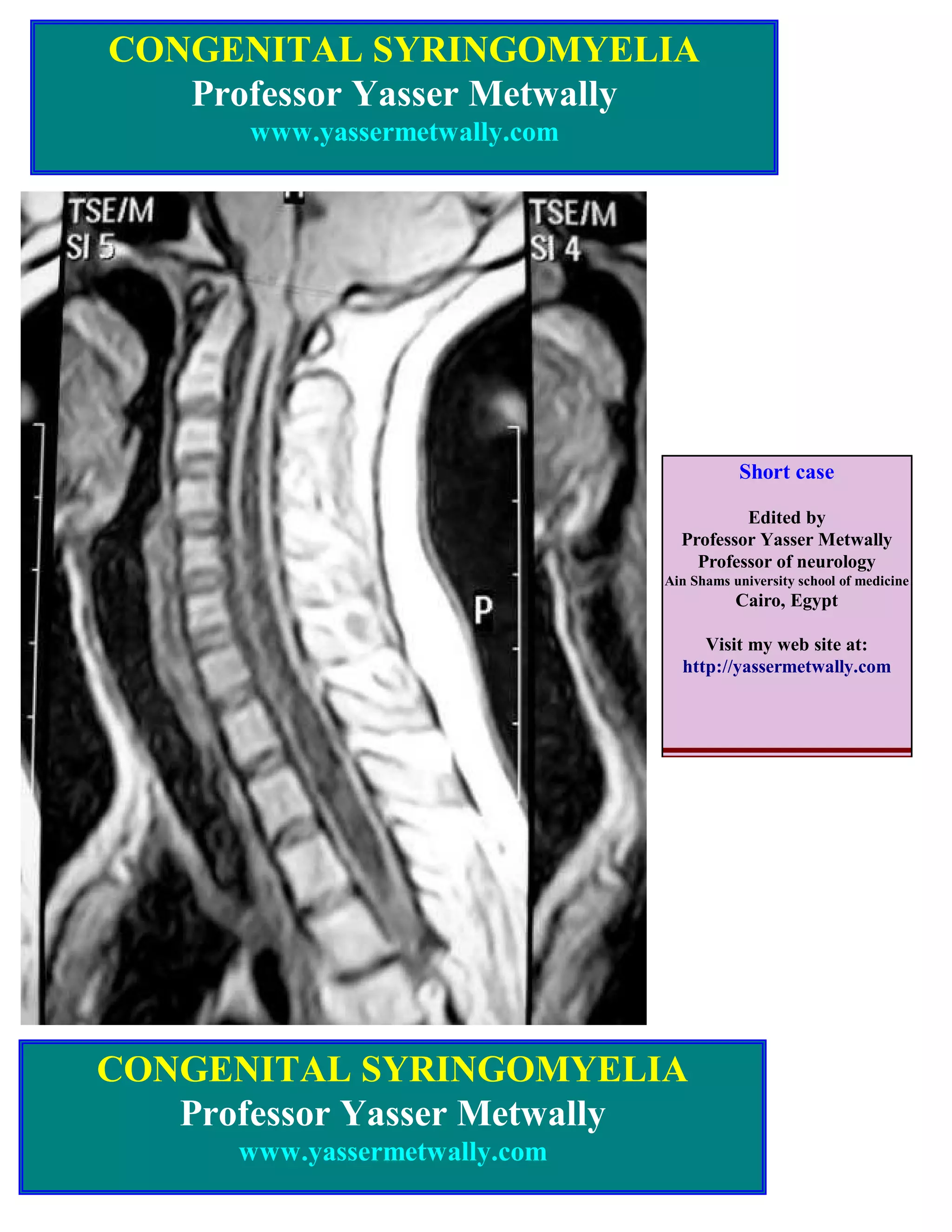 Short case...Congenital syringomyelia | PDF
