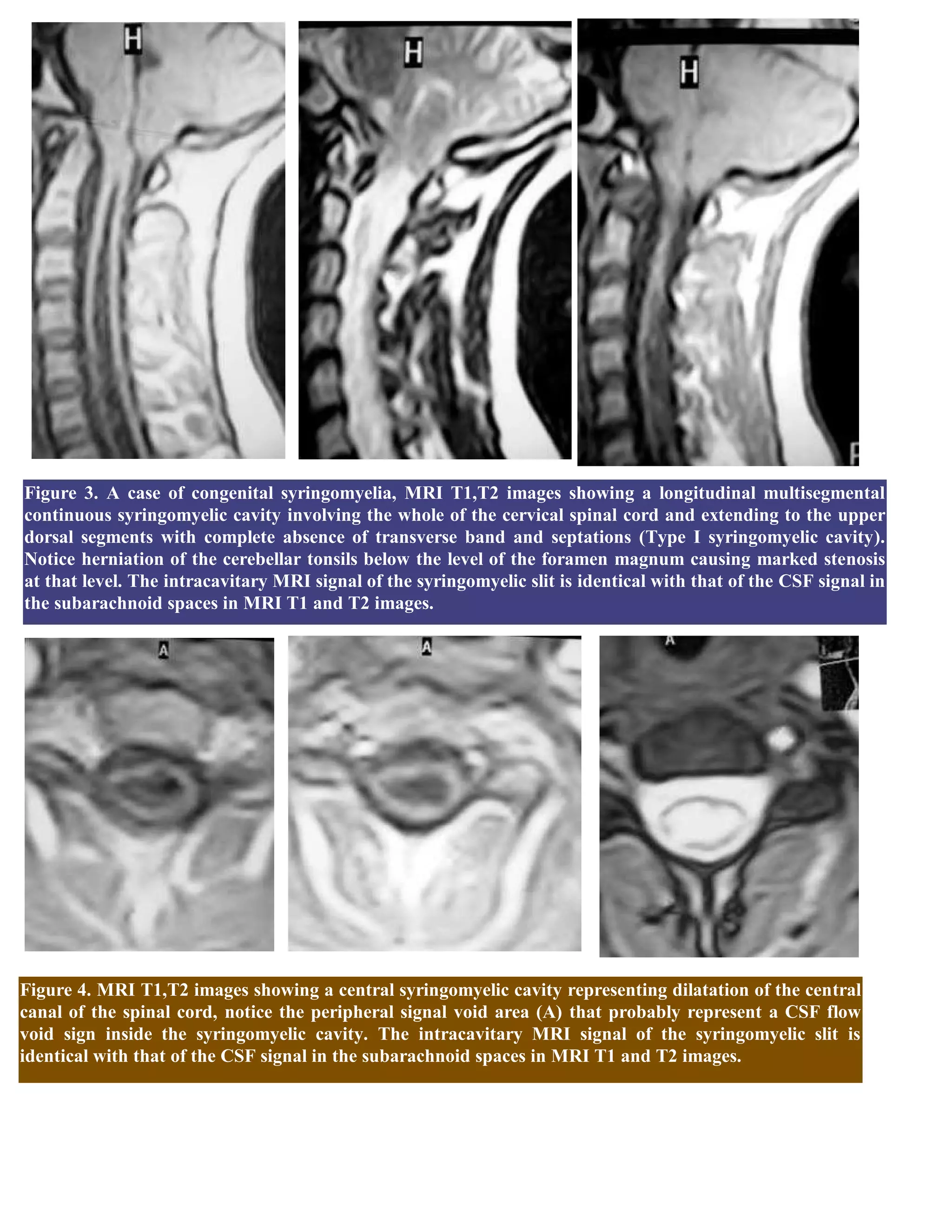 Short case...Congenital syringomyelia | PDF
