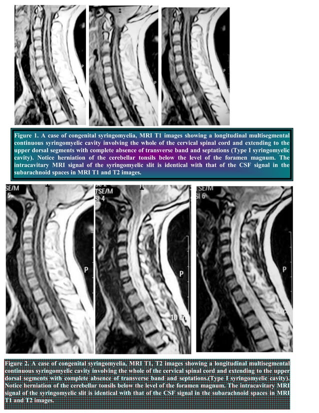 Short case...Congenital syringomyelia | PDF