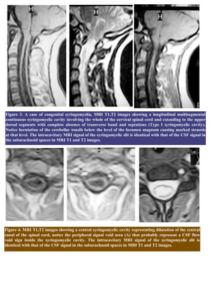 Short case...Congenital syringomyelia | PDF