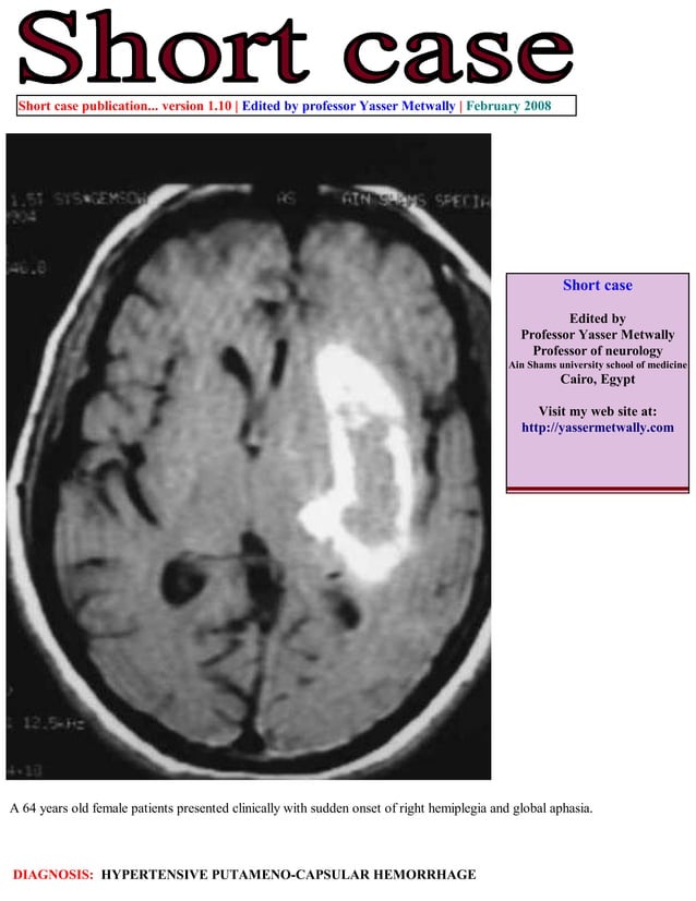 Short case..Subacute cerebral hemorrhage | PDF | Blood Disorders ...