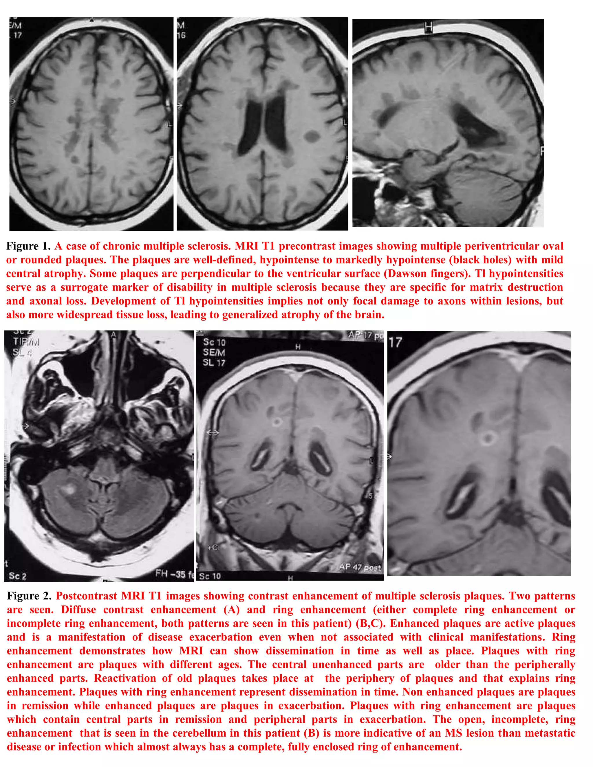 Short case...Multiple sclerosis | PDF