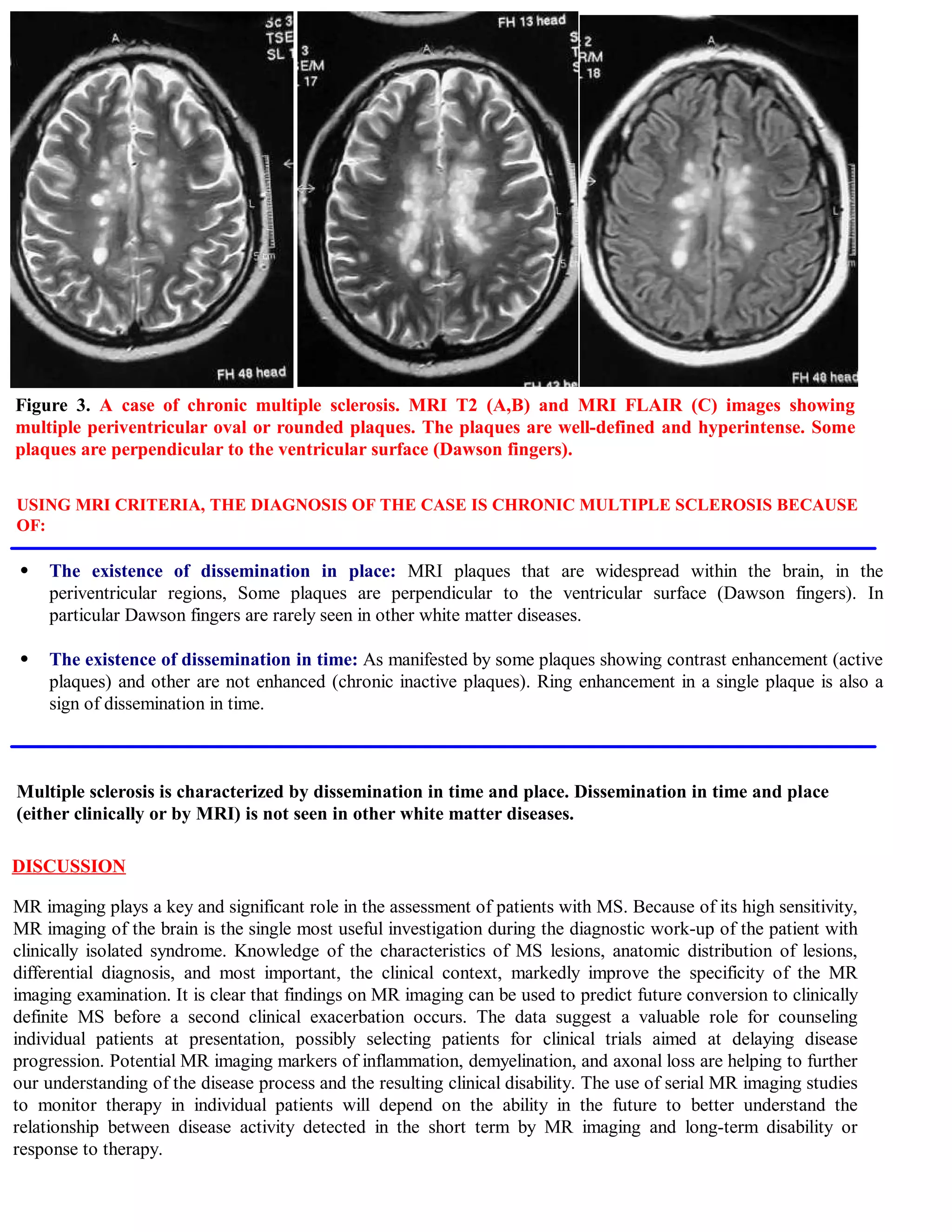 Short case...Multiple sclerosis | PDF